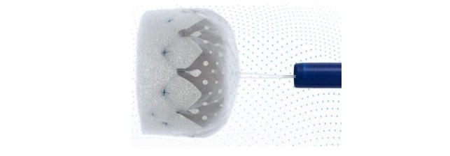 Left Atrial Appendage Occlusion Device Maker Conformal Medical Raises ...